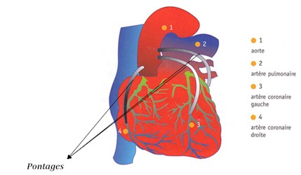 Citadelle - Service de Cardiologie - Liège - Le pontage coronaire
